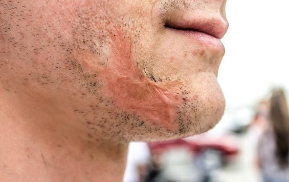 Suing For Disfigurement After A Pennsylvania Accident | Needle Law Firm